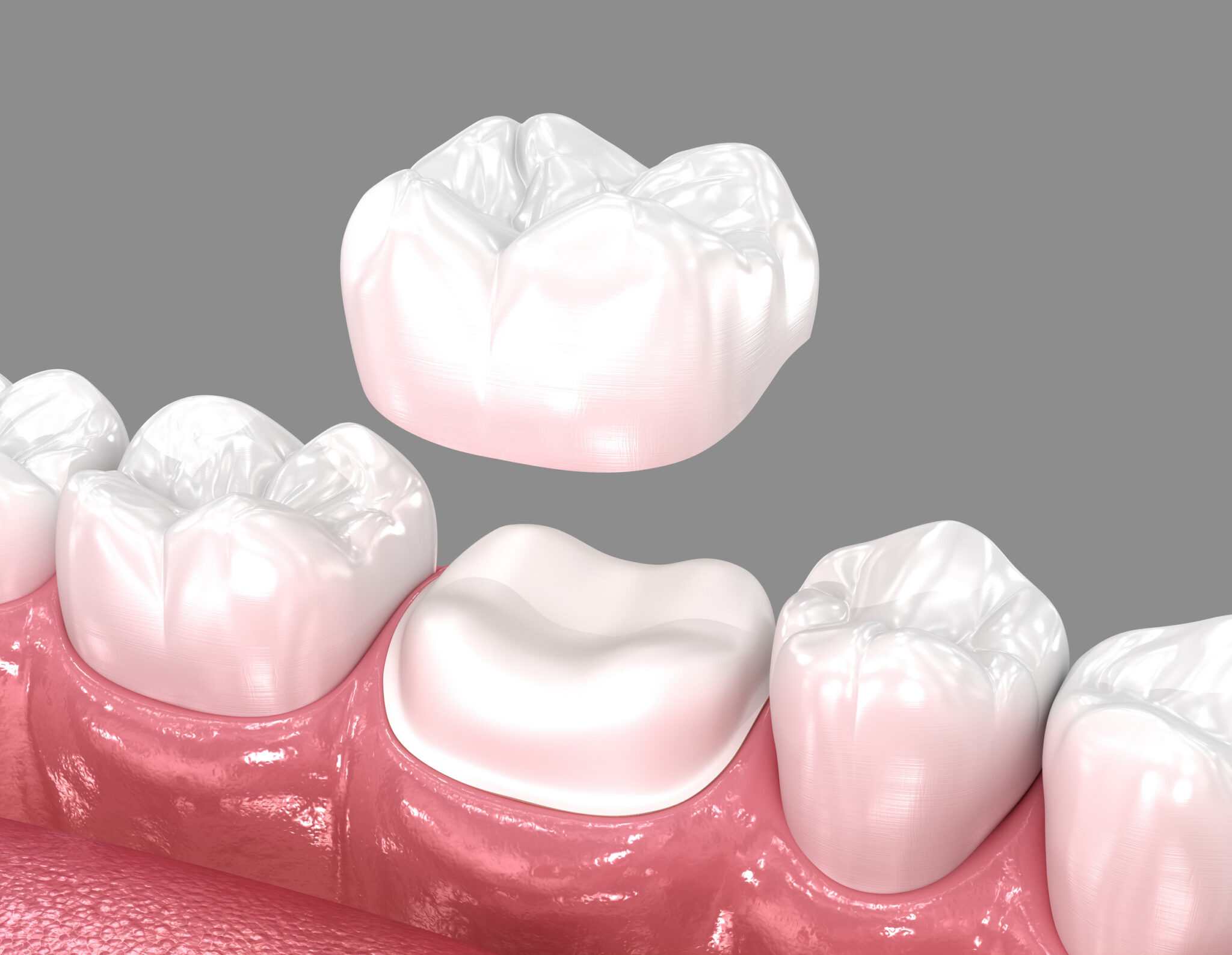 Crowns Provide Quality Restoration - Celina Family Dentistry